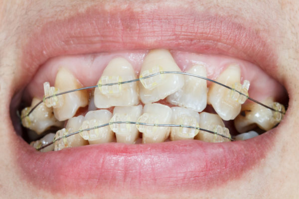 Ortodoncia y su tratamiento con frenillos dentales - Iván Lindo - Bogotá
